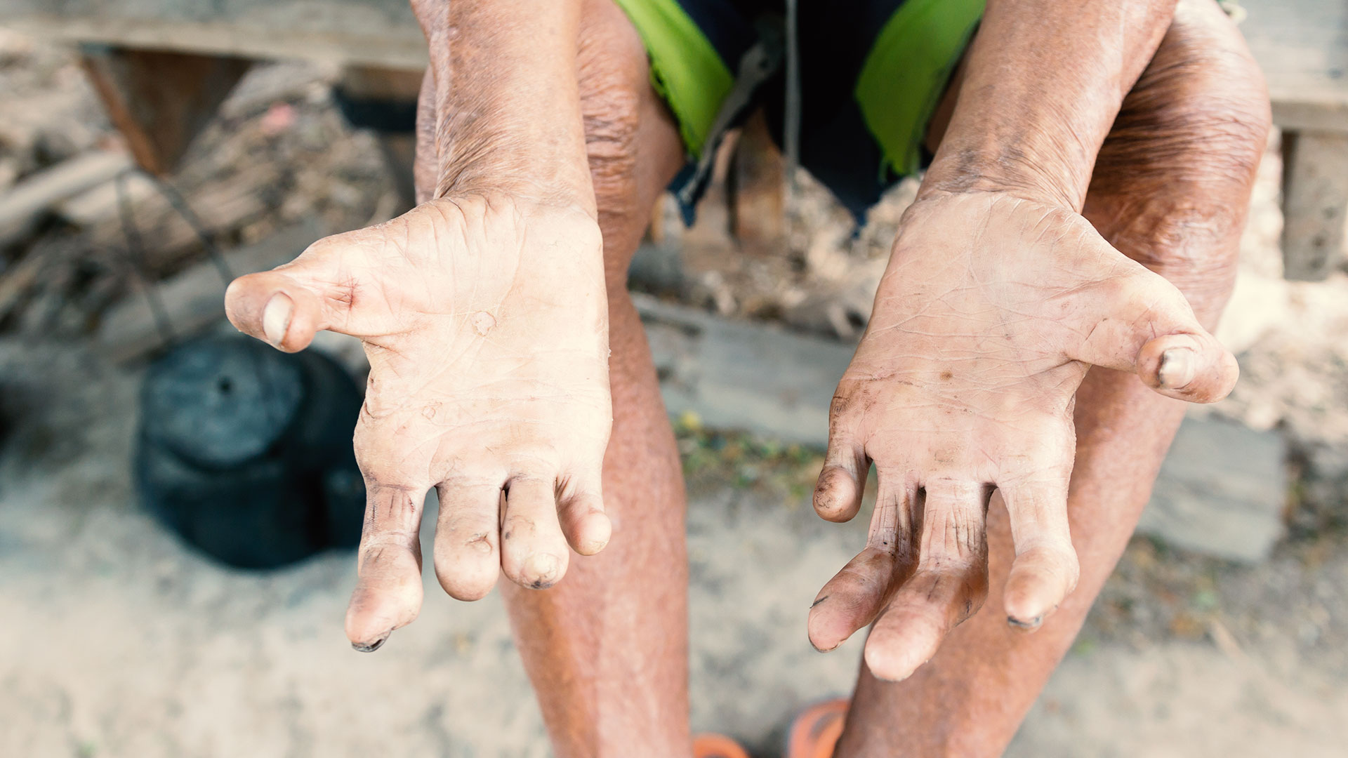 Cases of Leprosy Surge in Central Florida, CDC Warns Travelers It's Now ...